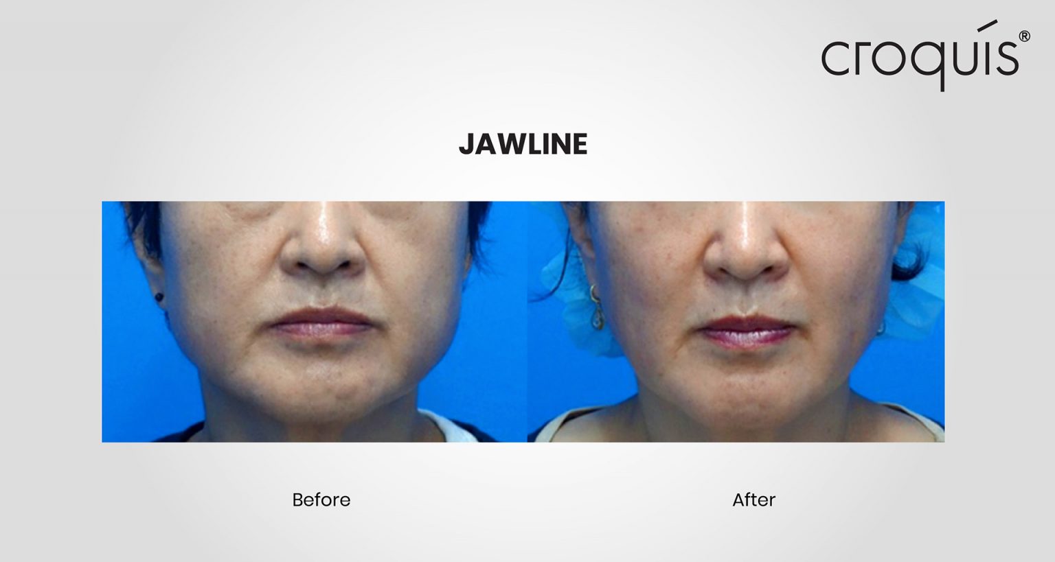 Thread Lift Before and After, Wajah Makin Tirus dan Kencang - Croquis